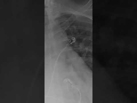 PICC line induced V Tach #picc #vtach