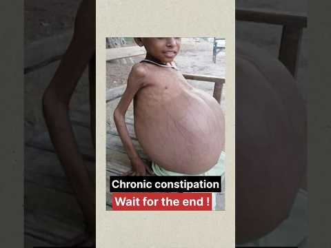 Condition started since birth. Chronic constipation. #neet #trending