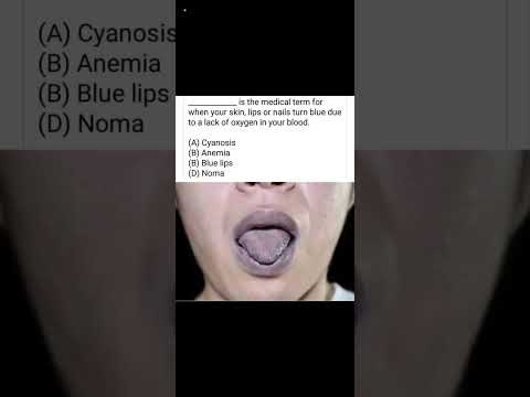 {Medical Quiz 55} bluish discoloration is called
