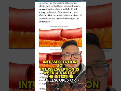 Some facts about intussusception. #health #wellness #interesting #fitness #nutrition