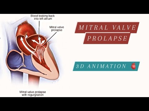 Understanding Mitral Valve Prolapse (MVP): Symptoms, Causes, Treatment | Heart Health | MedicoMind