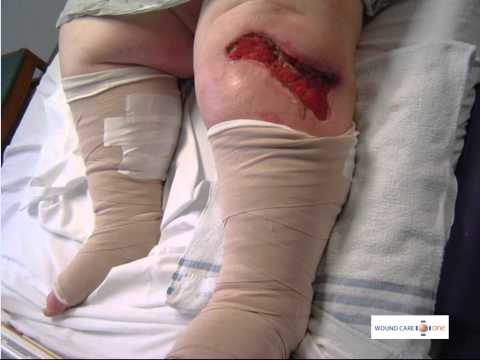 Granulation Tissue