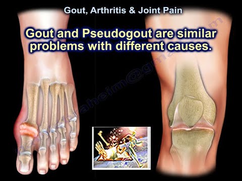 Gout, Pseudogout, and Joint Pain – Dr. Nabil Ebraheim's Blog