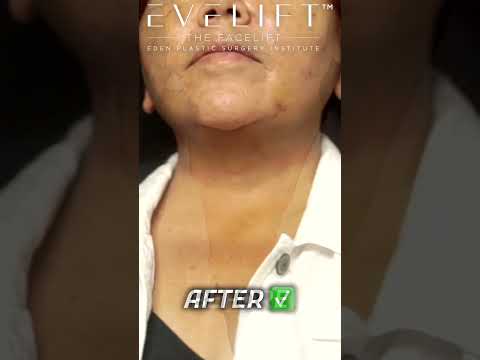 EVE Lift™ Before and Afters | Eden Plastic Surgery: Dr. Ali Charafeddine, MD