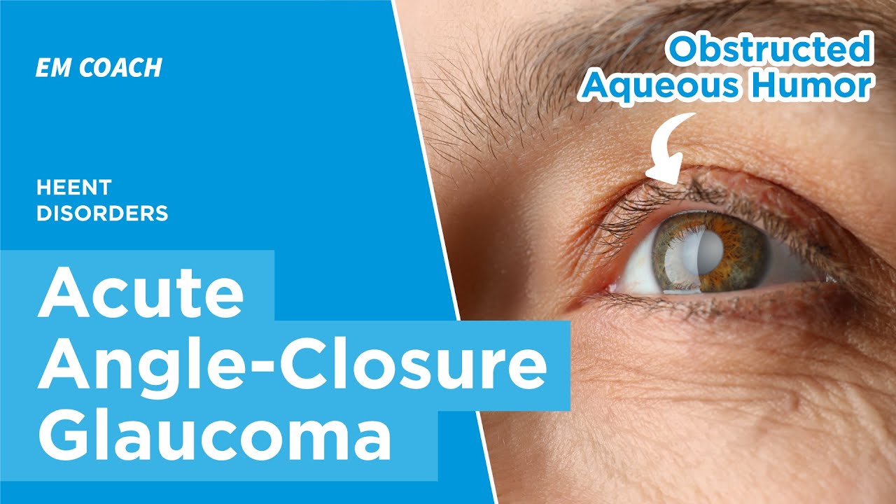 Acute Angle Closure Glaucoma