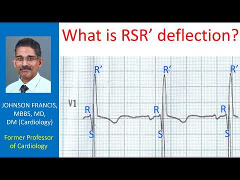 What is RSR' Deflection?