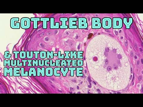"Gottlieb body" (eosinophilic inclusion) & Touton-like vacuolated melanocytes in nevus (pathology)