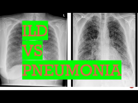 Chest X-ray/ interstitial lung disease vs Pneumonia/Types of opacities in lungs