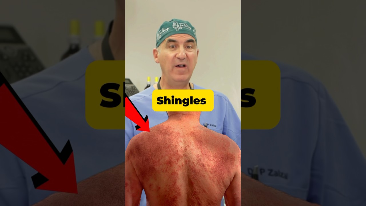 Shingles - You Don't Want This! #shorts