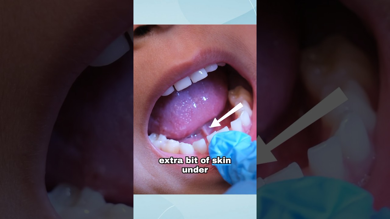 How can lip ties and tongue ties impact your life? 👅 #shorts #tonguetie #liptie