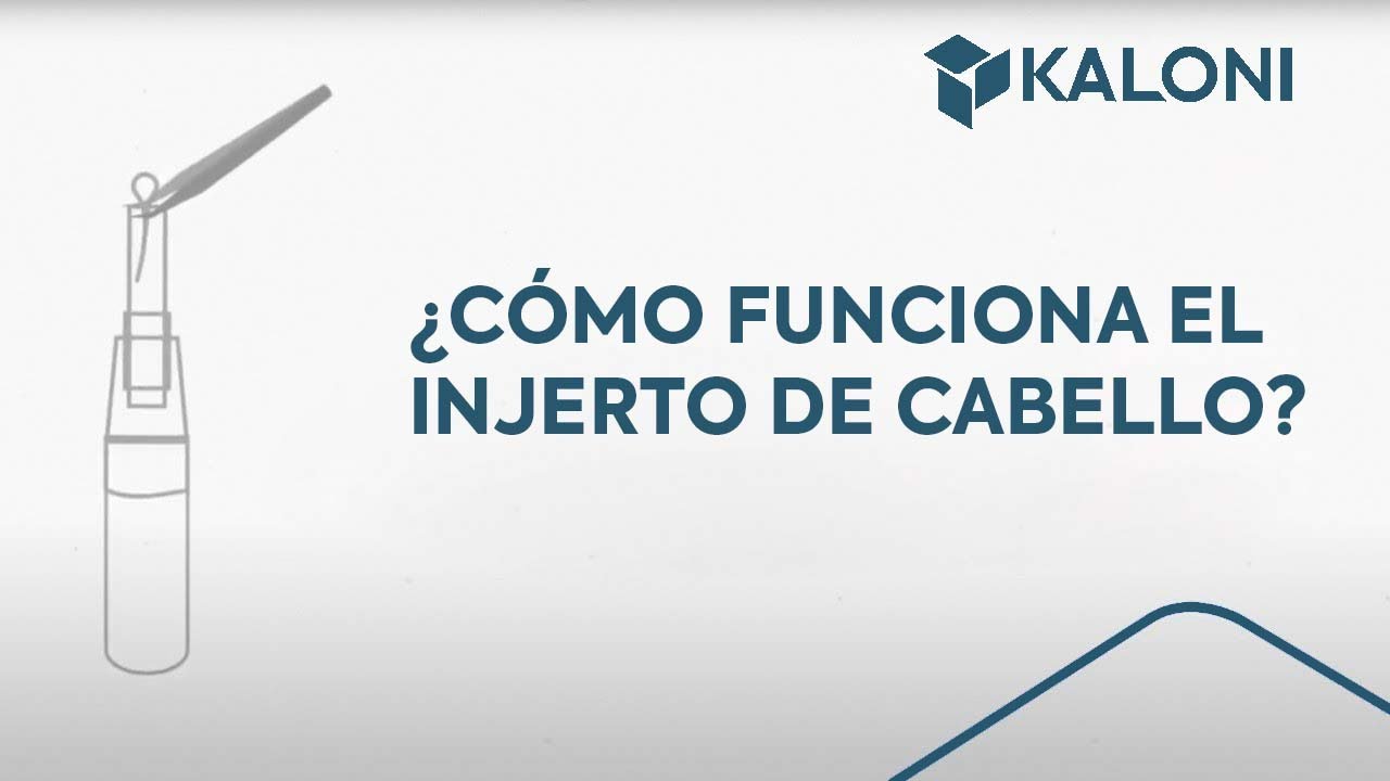 Descubre cómo y por qué funciona el Injerto de Cabello - Kaloni