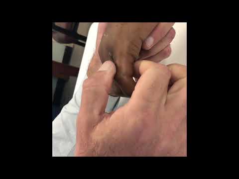 Proximal phalanx fracture direct blow