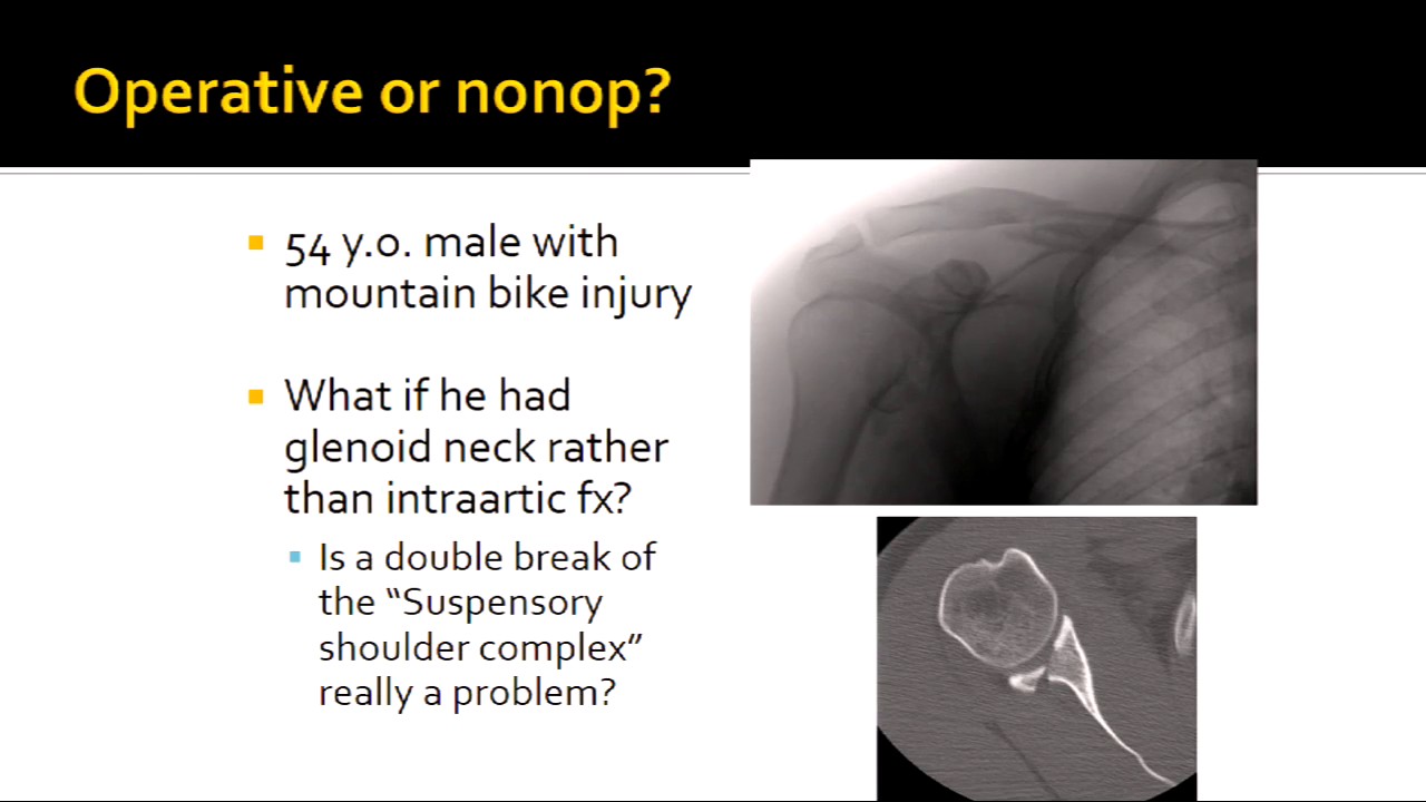 Clavicle fractures - Panel discussion