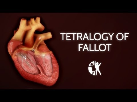 Tetralogy of Fallot | Cincinnati Children's