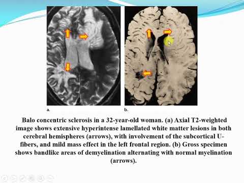 white matter disease with radiologic pathologic correlation