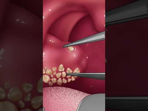 Tonsil Stone Treatment @smilebam #shortsfeed #viral #asmr #relaxingasmr #satisfying#relaxing#souls