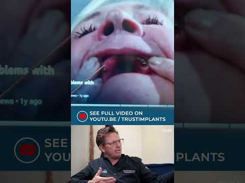 Millions Reported Problems with Dental Implants