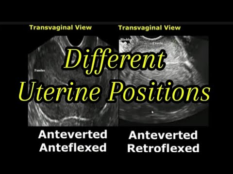 Uterine Positions In Ultrasound | Anteverted/Retroverted | Anteflexed/Retroflexed Uterus