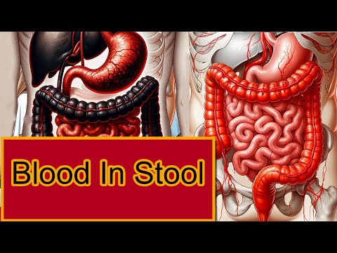 Blood In Stool: Melena Vs Hematochezia