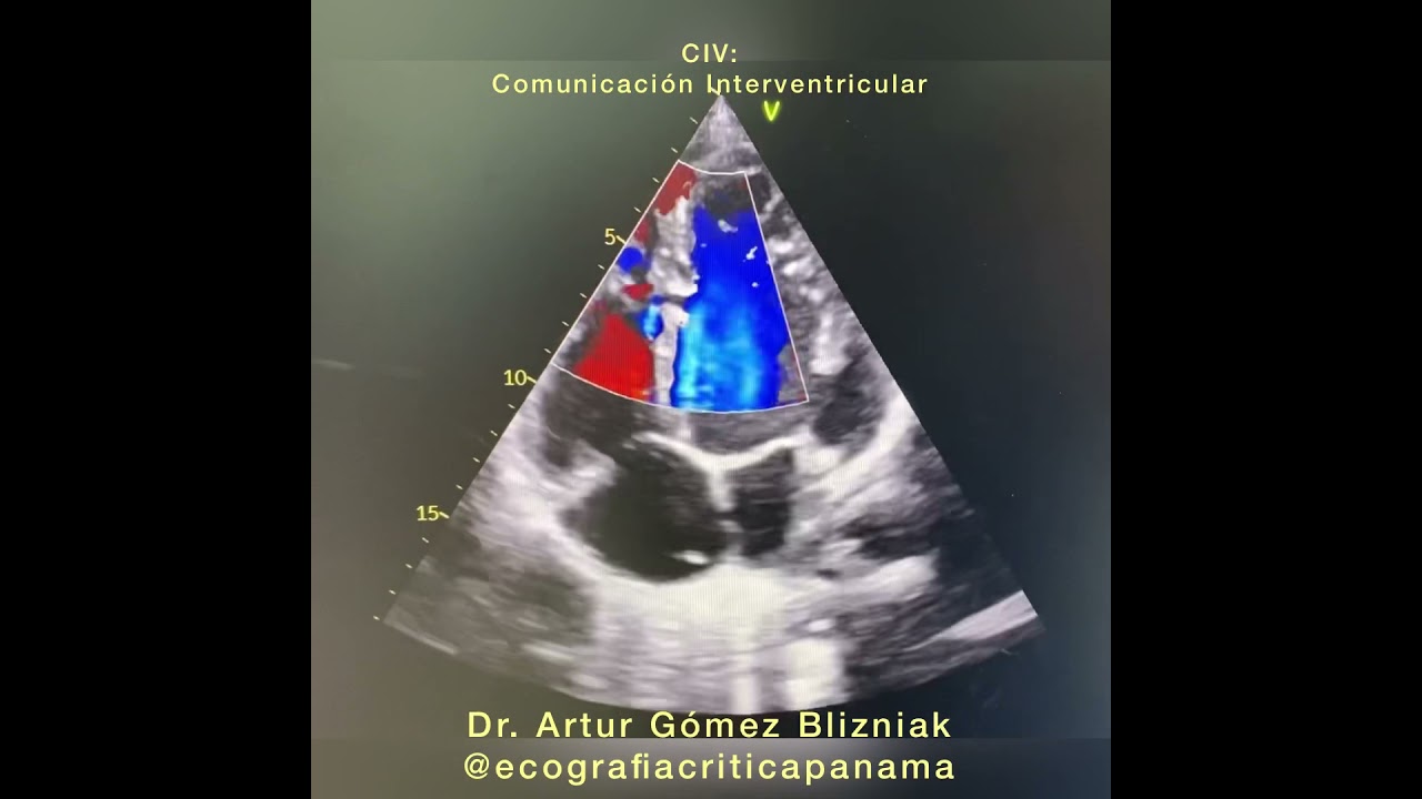 CIV: comunicación interventricular en UCI. Cirugia cardiovascular coloca parche.