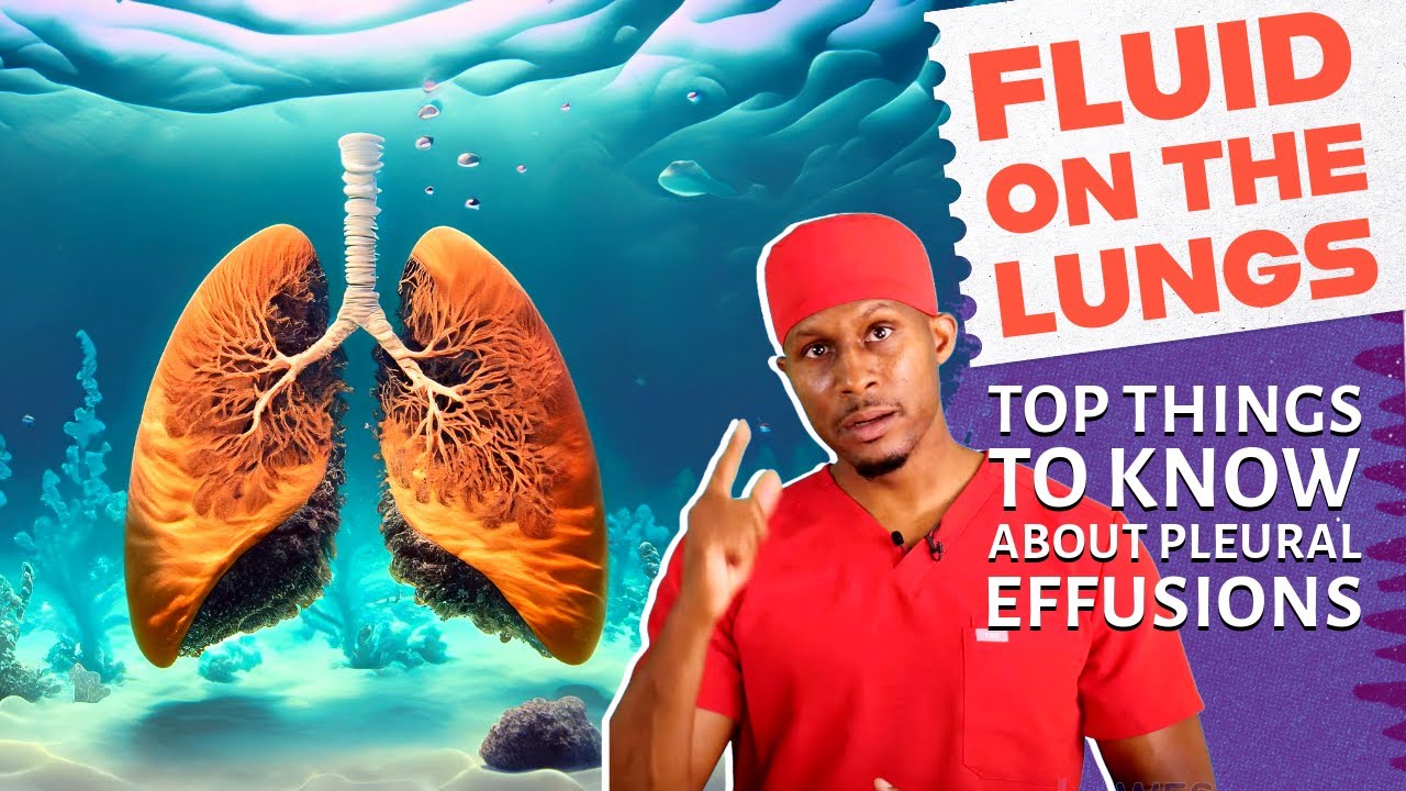 Top things to know about Pleural Effusions