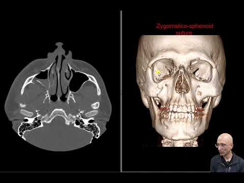ZMC fracture