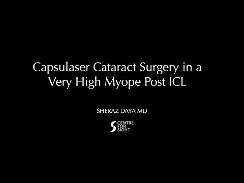 CAPSULaser ICL Exchange 2021