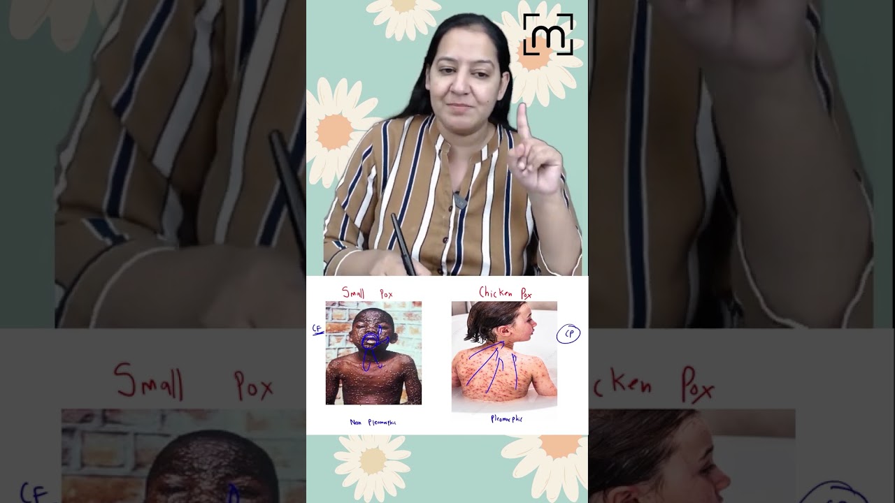 1 minute learning: Smallpox versus Chicken Pox Rash | MedLive | Dr. Priyanka Sachdev