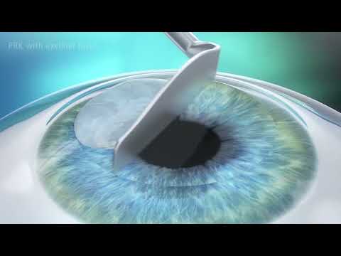 ZEISS Meditec Refractive Treatments- PRK