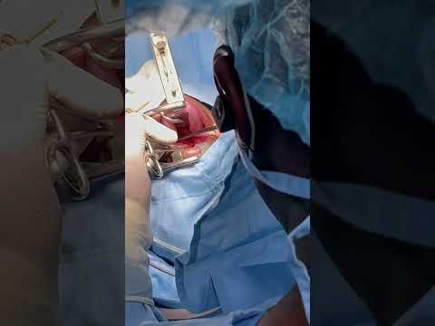 Part 2: Tonsillectomy with ECO ENT COOL PLASMA ELCTROSURGICAL SYSTEM