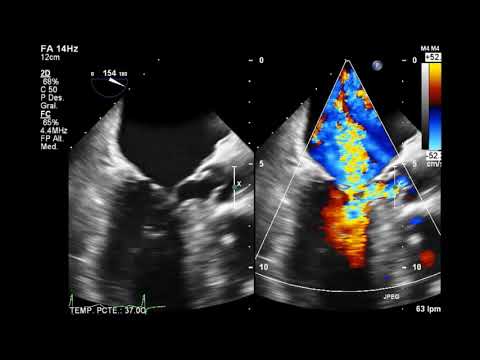 Echo and Systolic anterior motion (S A M)