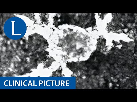 The limitations of diagnosing melanoma in vivo
