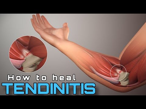 How to Heal Tendinitis Fast: PT-Recommended Strategies
