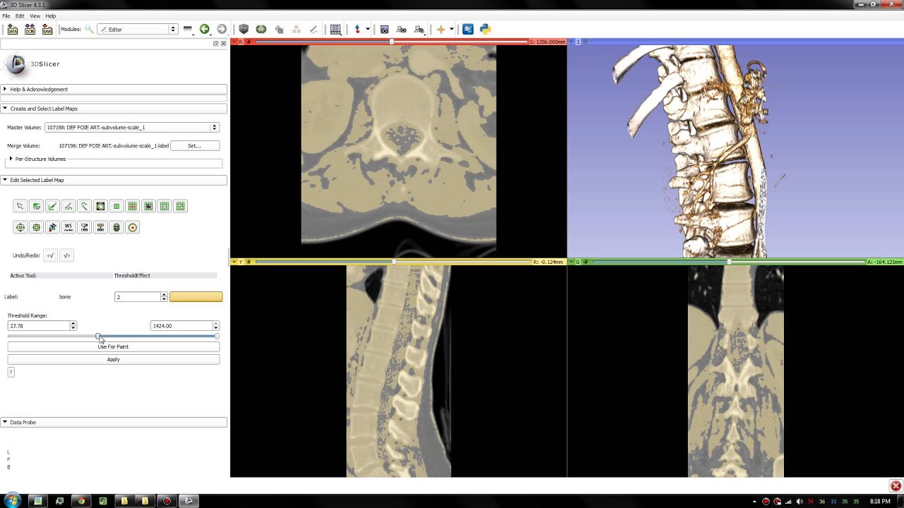 3D Slicer Tutorial - Spine Model