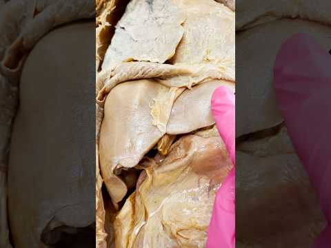 Cancerous Liver vs Healthy Liver