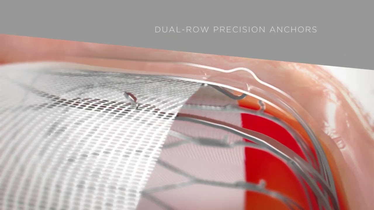 WATCHMAN procedure