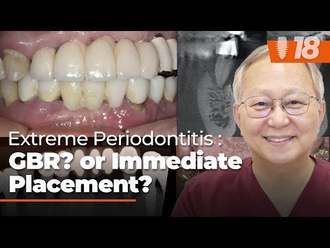 Extreme Periodontitis case ⎸ GBR or Immediate Placement?