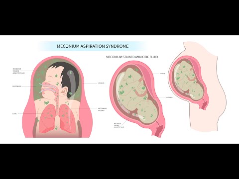 Meconium aspiration syndrome (MAS) ; Definition, Causes, Symptoms, Diagnosis, Treatment