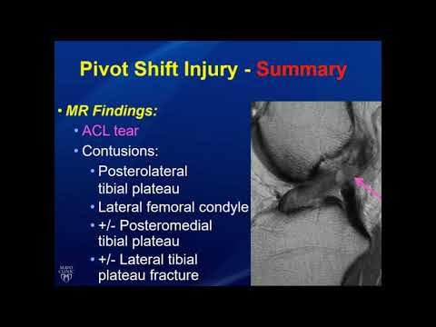 Knee MR: Recognizing Patterns of Injury
