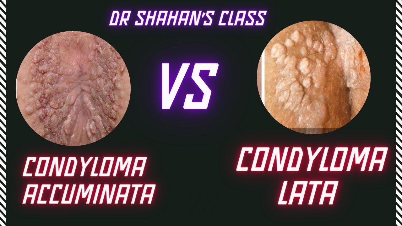 Condyloma Accuminata vs Condyloma Lata | Dermatology | FMGE NEETPG INICET
