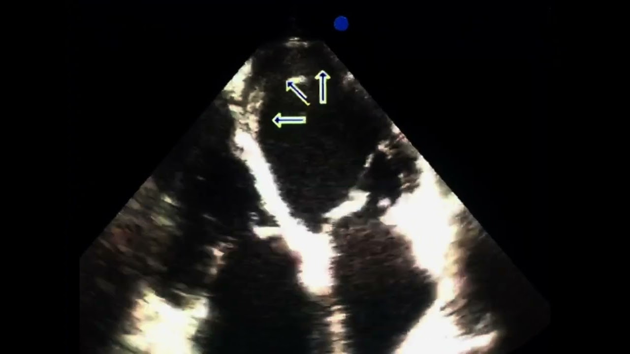 The Hidden Threat: How Easily a Left Ventricular Clot Can Be Overlooked