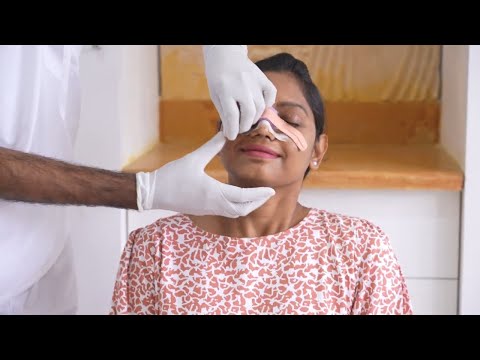 Wow ! What an wonderful Nose Makeover | Before & After | Dr. Sunil Richardson