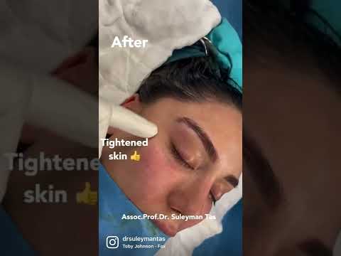 Fox Eyes Surgery | Dr. Suleyman TAS