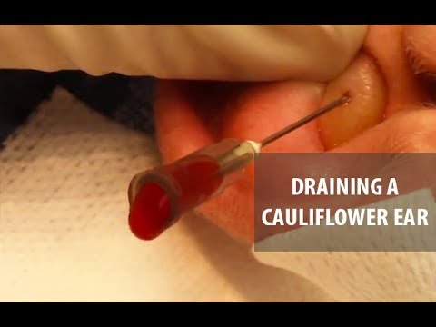 Draining a Cauliflower Ear | Dr. Derm