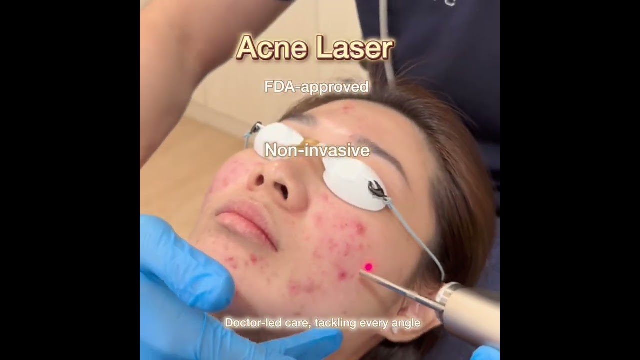 𝐀𝐜𝐧𝐞 𝐋𝐚𝐬𝐞𝐫 𝐓𝐫𝐞𝐚𝐭𝐦𝐞𝐧𝐭 @ $𝟖𝟖 𝐧𝐞𝐭𝐭Struggling to manage stubborn acne? 😞