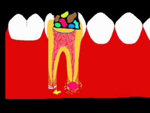 Dental Caries in hindi