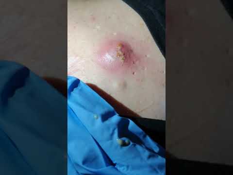 The biggest pimple pop of 2020?? EXPLODING Spot/Pimple/Cyst popping **please see description