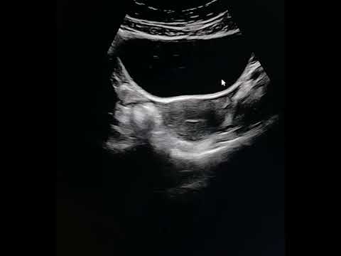 Why Do You Need A FULL Bladder For An Abdomen Scan? #abdomen #scan #drvandanaa #ultrasoundscans