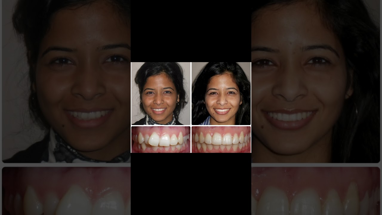 Removal of Premolars in Orthodontic Treatment- one reason to avoid #orthodontics #clearaligners