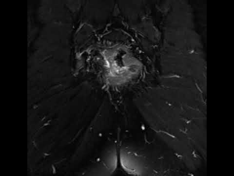 Female Pelvis MRI, Endometrial Implant